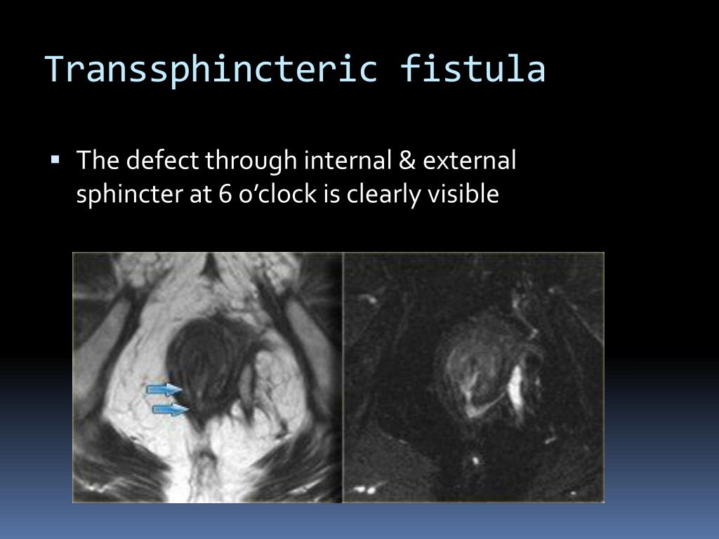 PPT - MRI imaging of Perianal fistula PowerPoint Presentation, free ...