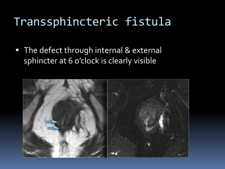 PPT - MRI imaging of Perianal fistula PowerPoint Presentation - ID:2986971