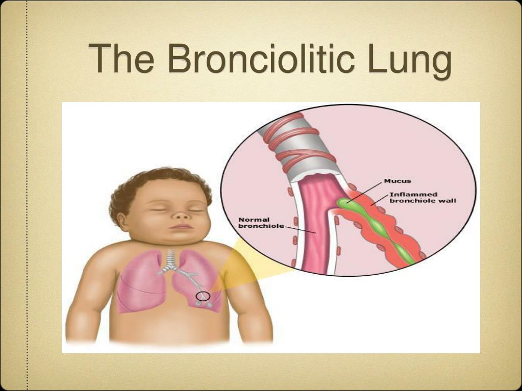 PPT - Asthma & Bronchiolitis in the Hospitalized Pediatric Patient ...