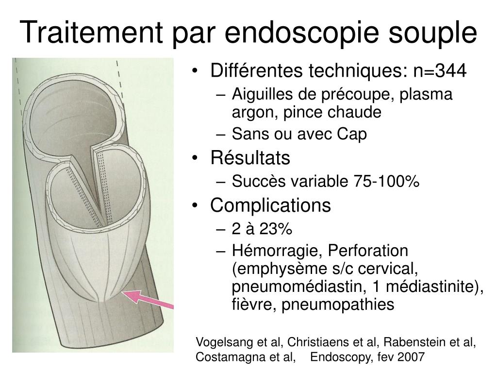PPT - Traitement endoscopique du diverticule de Zenker par myotomie du ...