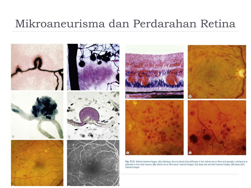PPT - Diskusi Topik Mata Tenang dan Visus Turun Mendadak PowerPoint ...