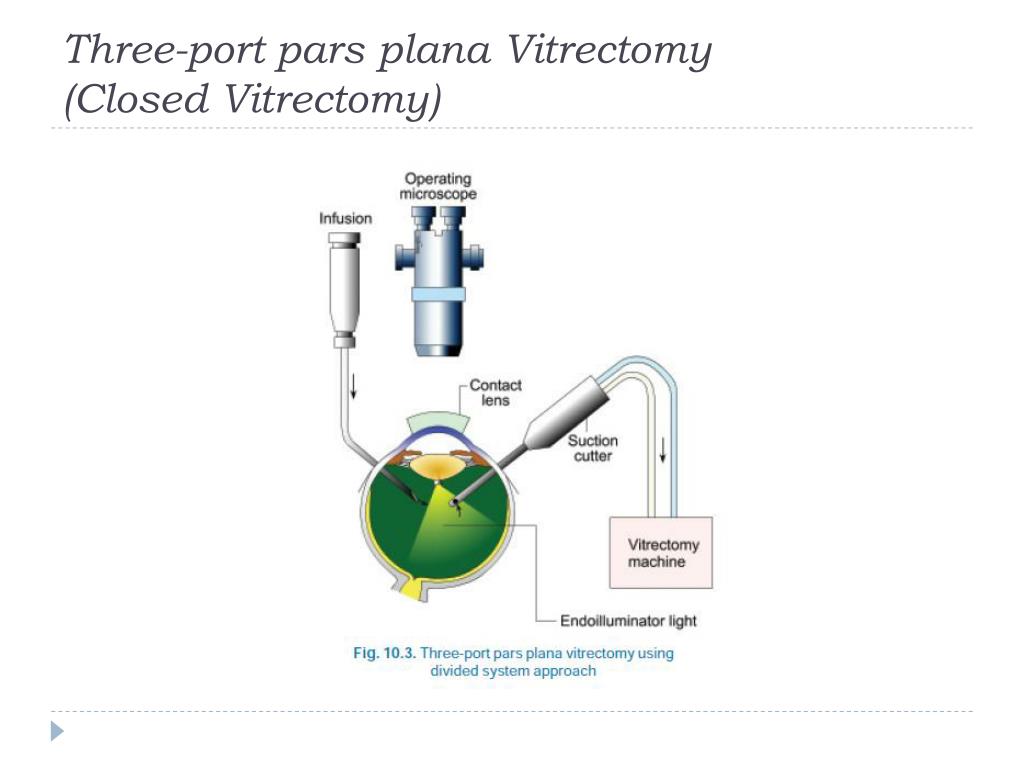 PPT - Diskusi Topik Mata Tenang dan Visus Turun Mendadak PowerPoint ...