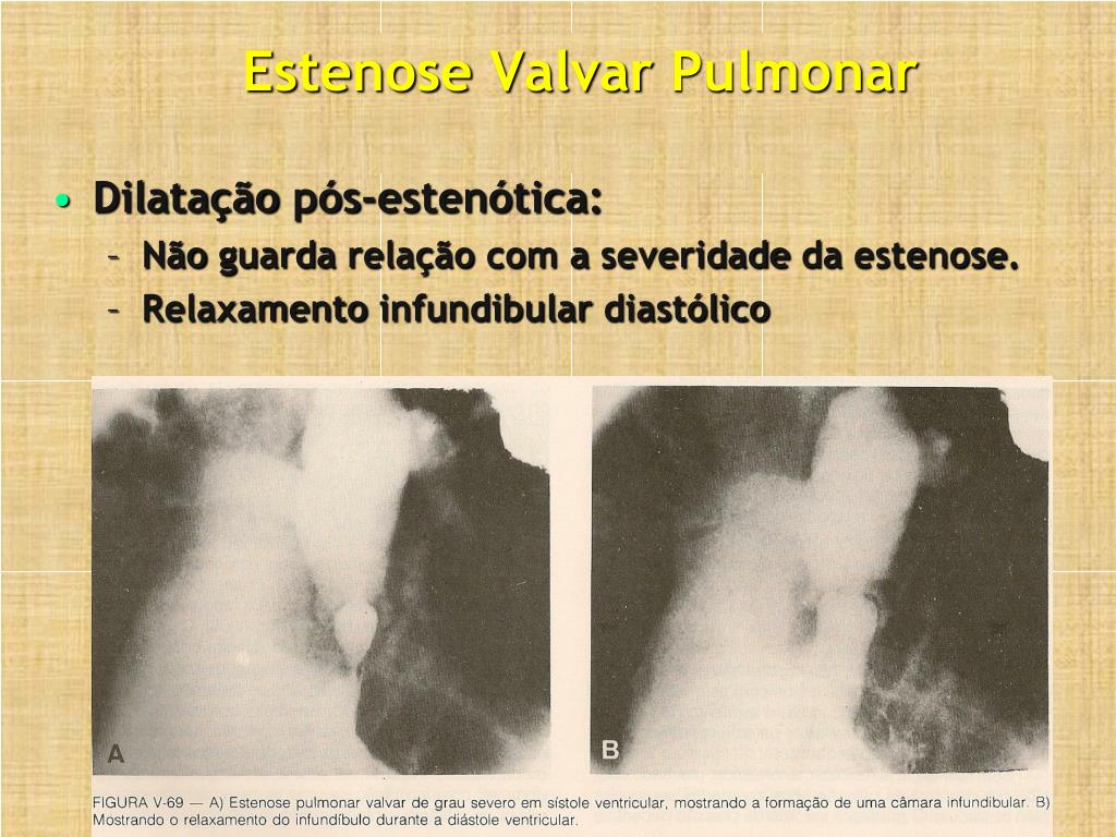 PPT - Intervenção Percutânea em Estenose Valvar Pulmonar PowerPoint ...