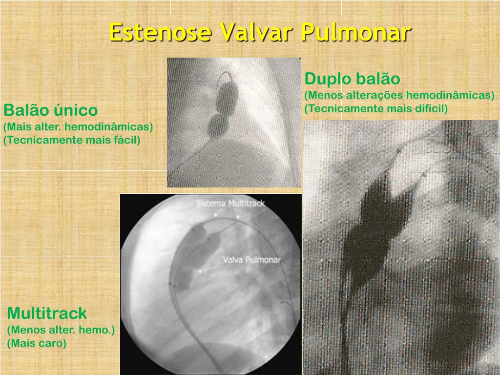 PPT - Intervenção Percutânea em Estenose Valvar Pulmonar PowerPoint ...