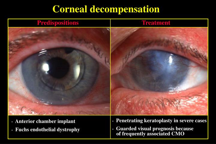 Ppt Complications Of Cataract Surgery Powerpoint Presentation Id