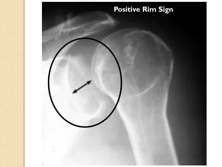 PPT - Radiography of the Shoulder PowerPoint Presentation - ID:3000947