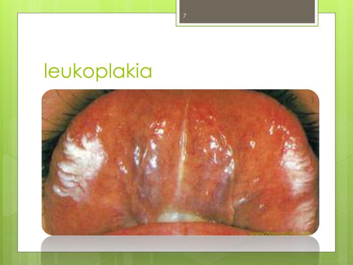 PPT - Pre-malignant lesions of Oral cavity PowerPoint Presentation - ID ...