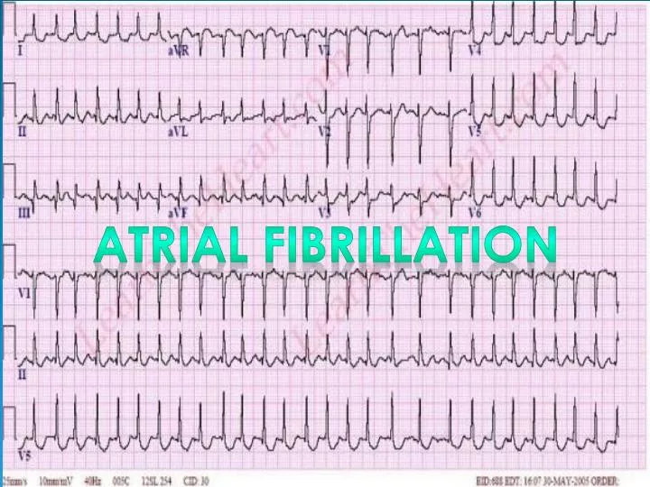 PPT - ATRIAL FIBRILLATION PowerPoint Presentation, free download - ID ...