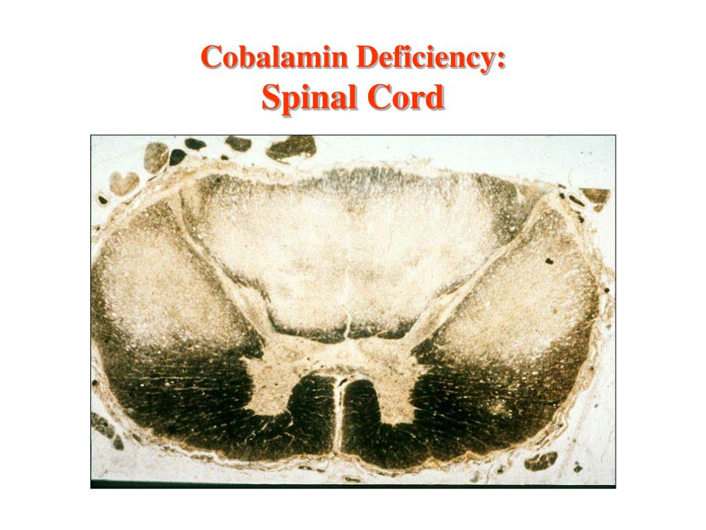 PPT - The Megaloblastic Anemias: Vitamin B 12 & Folate Deficiency ...