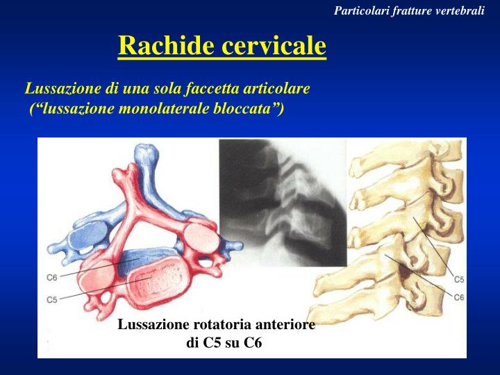 PPT - Fratture vertebrali PowerPoint Presentation - ID:3004151