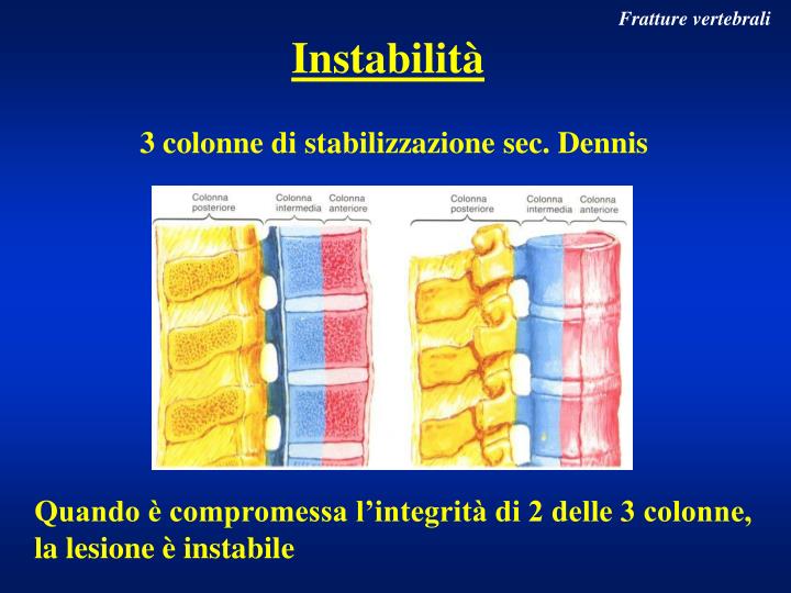 PPT - Fratture vertebrali PowerPoint Presentation - ID:3004151