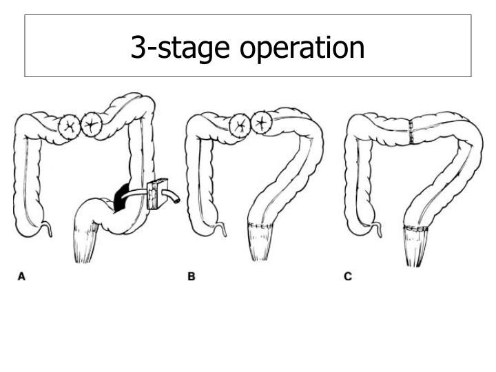 PPT - Diverticular disease PowerPoint Presentation - ID:3004185