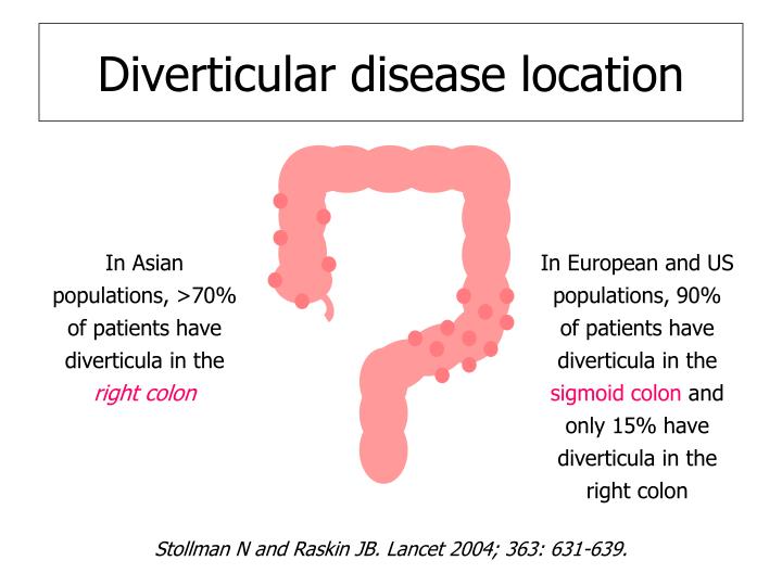 PPT - Diverticular disease PowerPoint Presentation - ID:3004185