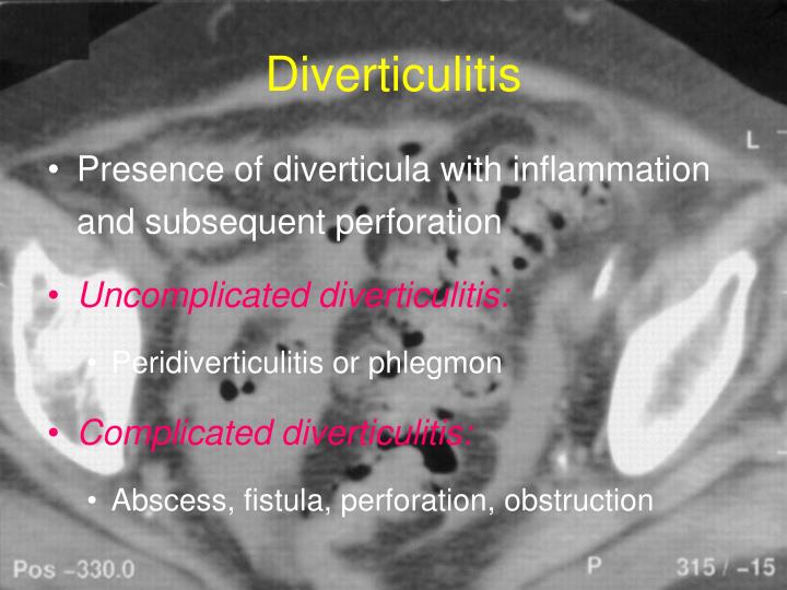 PPT - Diverticular disease PowerPoint Presentation - ID:3004185
