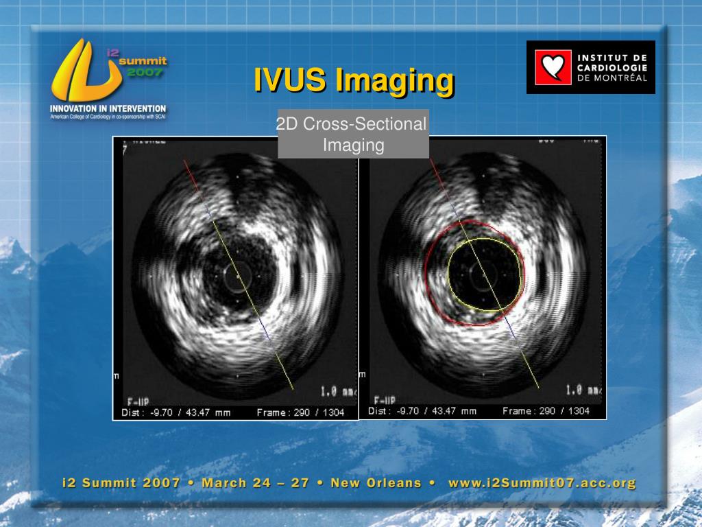 PPT - Navigating the Coronary Circulation : Angiography vs IVUS Pearls ... PPT - Navigating the Coronary Circulation : Angiography vs IVUS Pearls ...