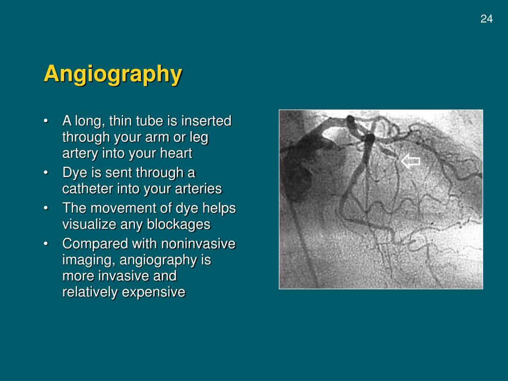 PPT - Women and Coronary Artery Disease (CAD) PowerPoint Presentation ...