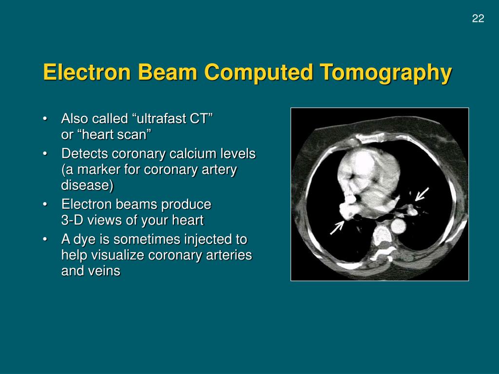 PPT - Women and Coronary Artery Disease (CAD) PowerPoint Presentation ...