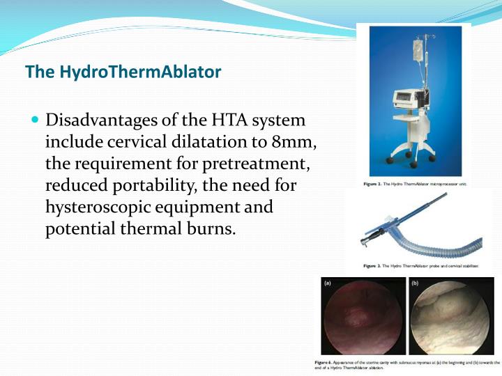 PPT - Endometrial Ablation Techniques PowerPoint Presentation - ID:3007603