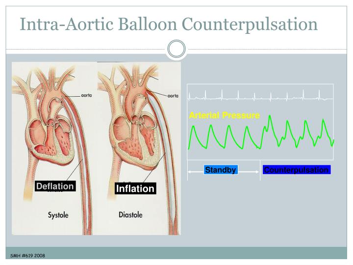 PPT - Cardiogenic Shock PowerPoint Presentation - ID:3009162