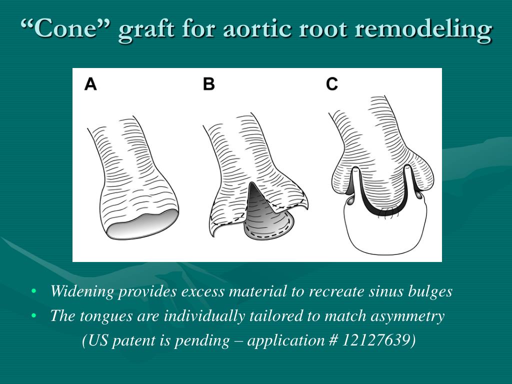 PPT - Sinus Valsalva asymmetry is the “normal” aortic root anatomy ...