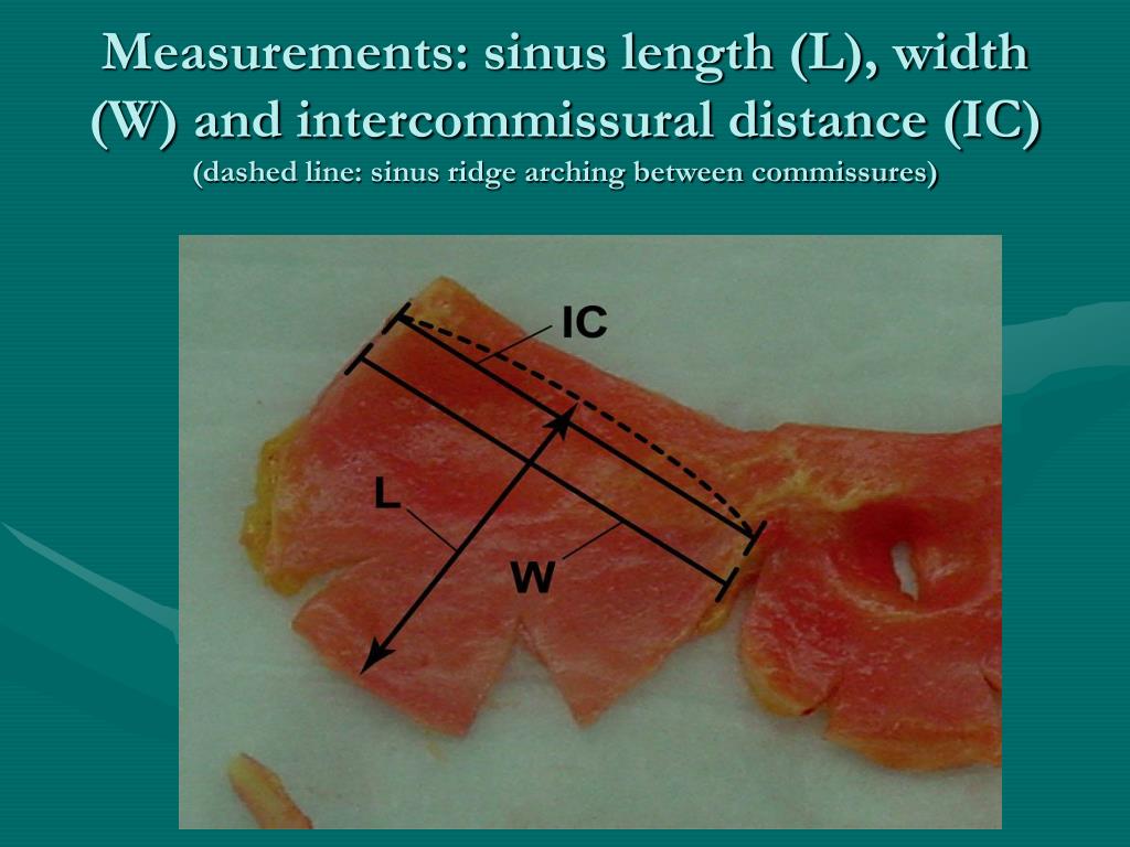 PPT - Sinus Valsalva asymmetry is the “normal” aortic root anatomy ...