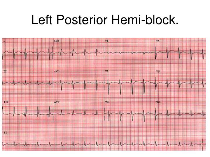 PPT - Ventricular Conduction Disorders. PowerPoint Presentation - ID ...