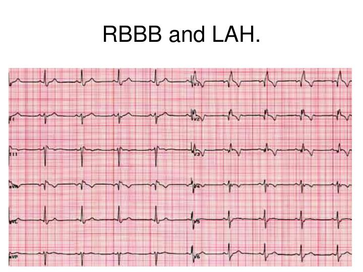 PPT - Ventricular Conduction Disorders. PowerPoint Presentation - ID ...