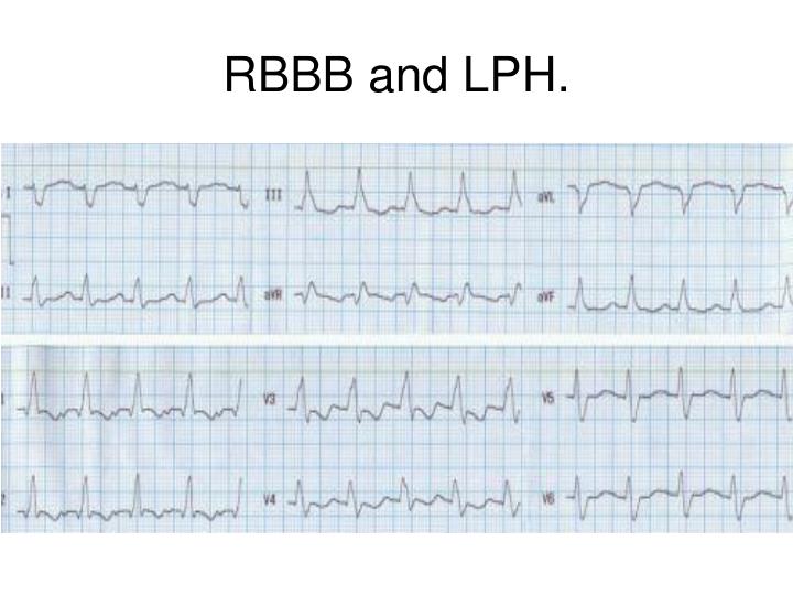 PPT - Ventricular Conduction Disorders. PowerPoint Presentation - ID ...