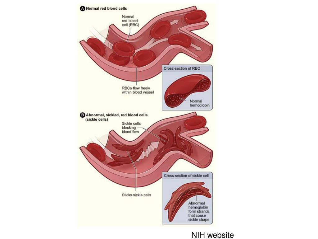 PPT - Sickle Cell - Pain Crisis and Acute Chest Syndrome PowerPoint ...