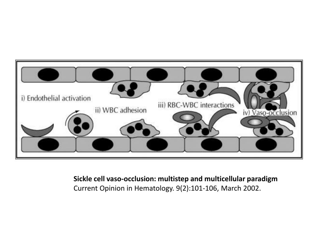 PPT - Sickle Cell - Pain Crisis and Acute Chest Syndrome PowerPoint ...