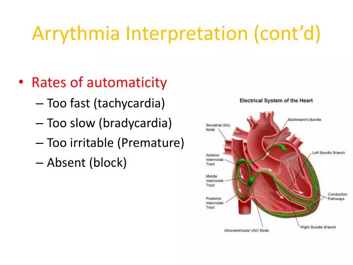 PPT - Arrythmia Interpretation (cont’d) PowerPoint Presentation, free ...