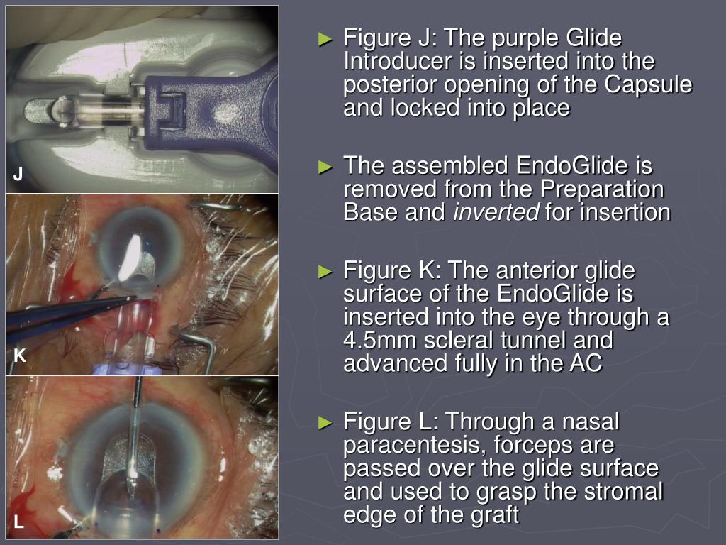 PPT - Dr Wei-Boon KHOR, MRCS(Ed), Dr Jodhbir S MEHTA, FRCS(Ed), Prof ...