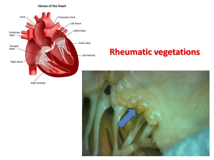 PPT - Endocarditis PowerPoint Presentation - ID:3014184
