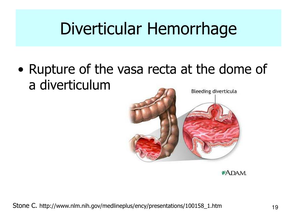 PPT - Diverticular Disease and Hemorrhoids PowerPoint Presentation ...