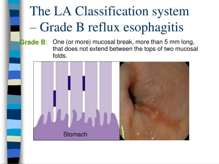 PPT - GASTROESOPHAGEAL REFLUX DISEASE. . PowerPoint Presentation - ID ...