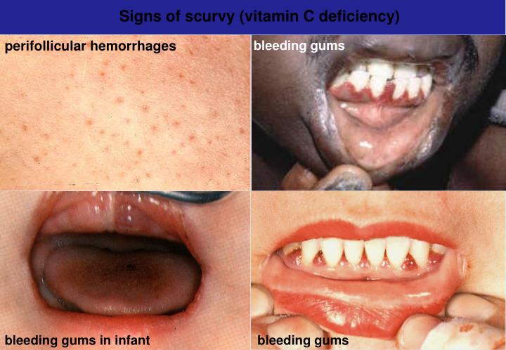 PPT - Clinical signs of micronutrient deficiencies PowerPoint ...