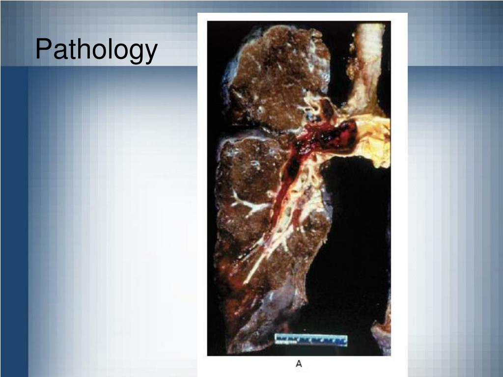 Ppt Pulmonary Embolism Powerpoint Presentation Free Download Id