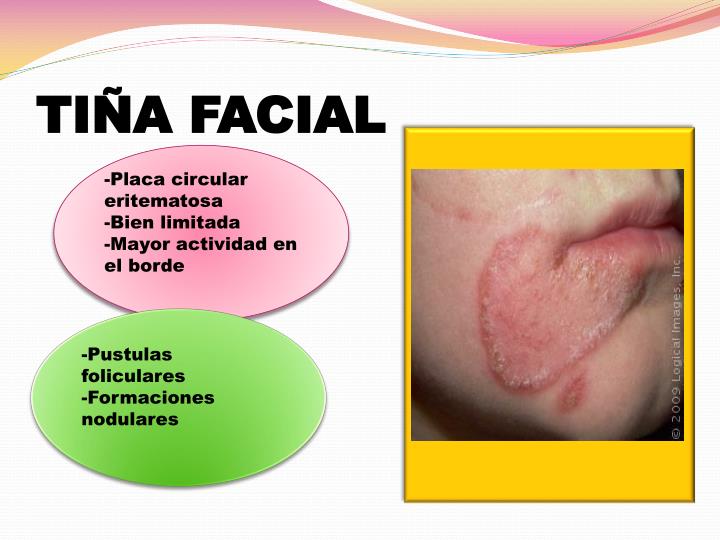 PPT - DERMATOSIS MÁS FRECUENTES EN PEDIATRÍA PowerPoint Presentation ...
