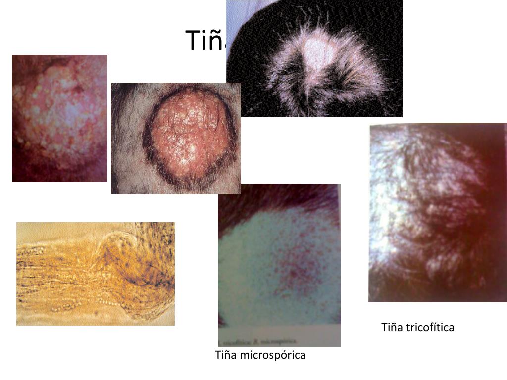 PPT - Enfermedades Fúngicas Superficiales PowerPoint Presentation, free ...