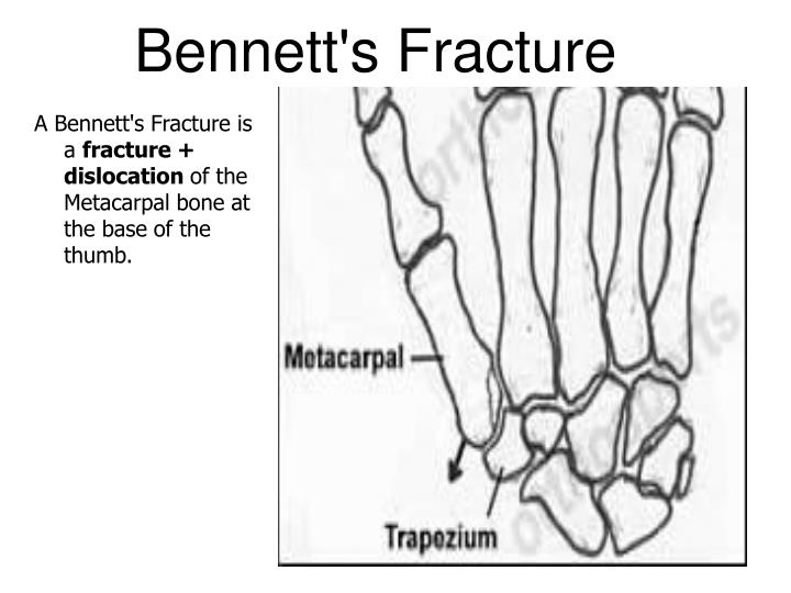 PPT - Hand and Wrist PowerPoint Presentation - ID:3021090