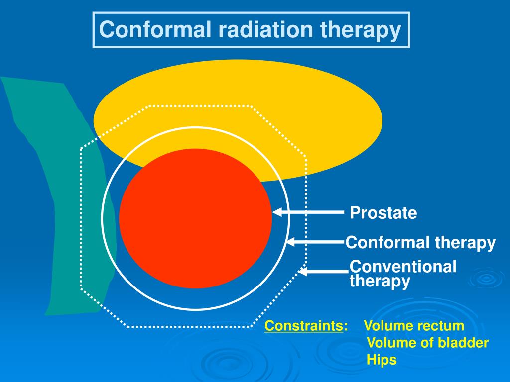 PPT - PROSTATE CANCER: RADIATION THERAPY APPROACHES PowerPoint ...
