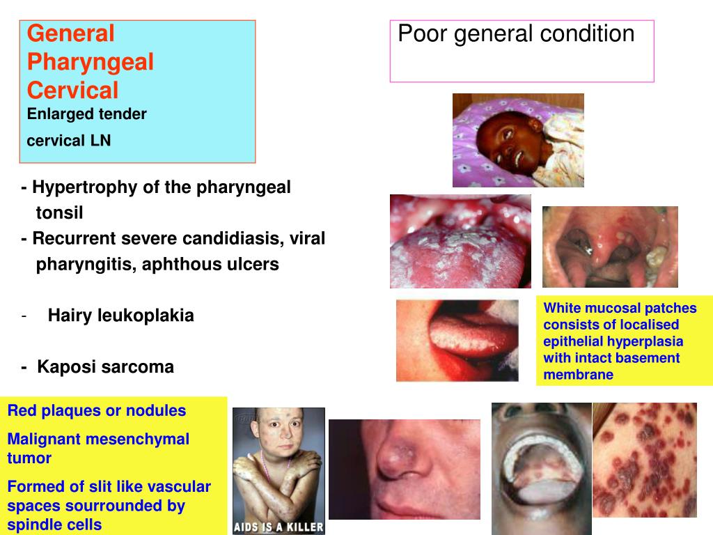 PPT - Acute Chronic Pharyngeal manifestations of systemic diseases ...