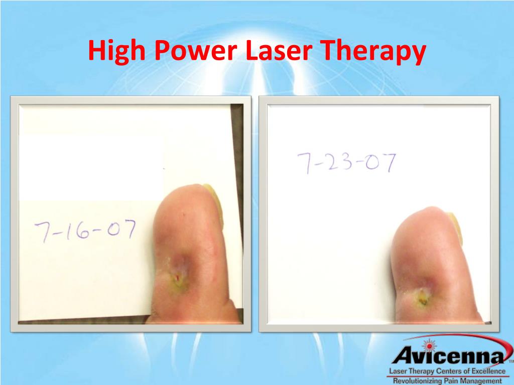 PPT - Wound Healing using the AVI HP- 7.5 Therapeutic Laser PowerPoint ...