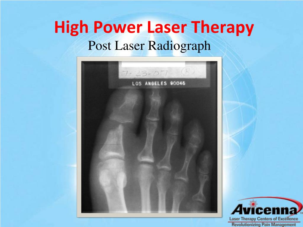 PPT - Wound Healing using the AVI HP- 7.5 Therapeutic Laser PowerPoint ...