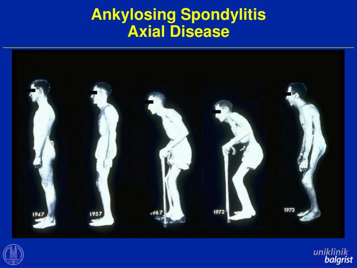 PPT - Role of MRI in Assessment and Diagnosis of Axial ...