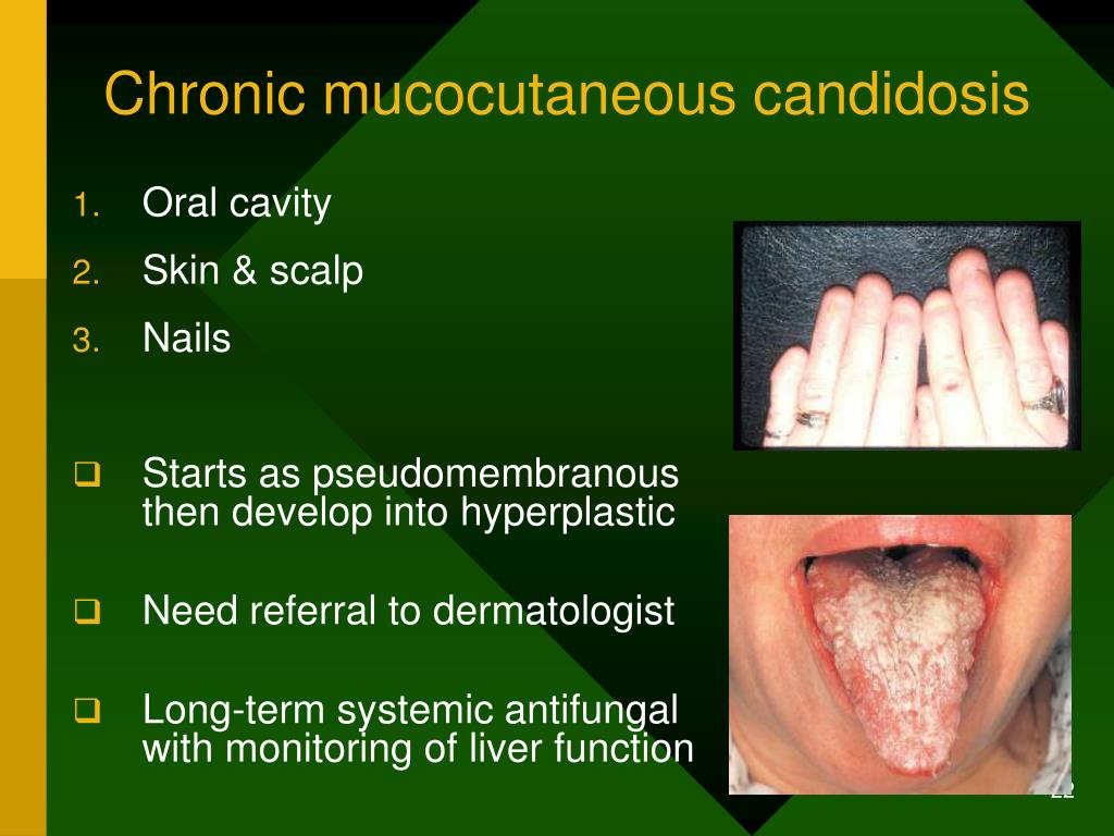 PPT - Fungal Infection Candidadiasis (Candidosis) PowerPoint ...