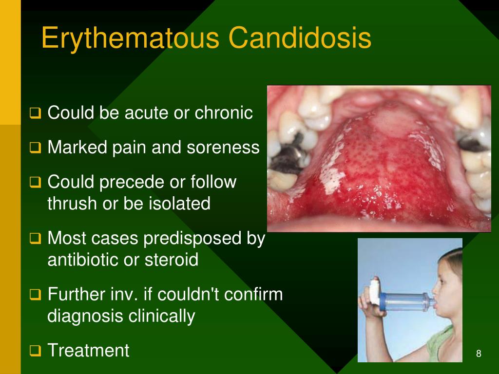 PPT - Fungal Infection Candidadiasis (Candidosis) PowerPoint ...