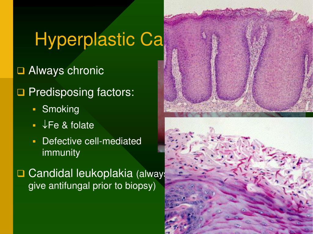 PPT - Fungal Infection Candidadiasis (Candidosis) PowerPoint ...