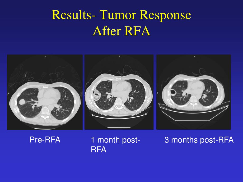 PPT - AATS Focus on Thoracic Surgery : Lung Cancer November 16, 2012 ...