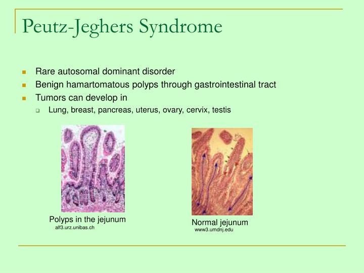 PPT - Peutz-Jeghers Syndrome (PJS) and LKB1 PowerPoint Presentation ...